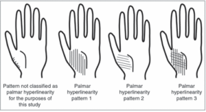 皮膚バリア機能異常を、手のしわ(palmar hyperlinearity)で予想できるかもしれない